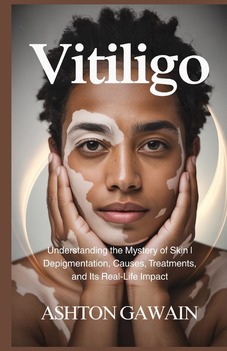 Vitiligo a book by Ashton Gawain - Bookshop.org US